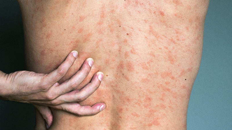 Stress Rashes and Stress Hives: Tips and Treatments - Senior Fitness
