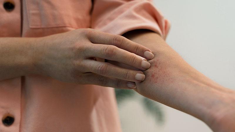 Stress Rashes and Stress Hives: Tips and Treatments - Senior Fitness