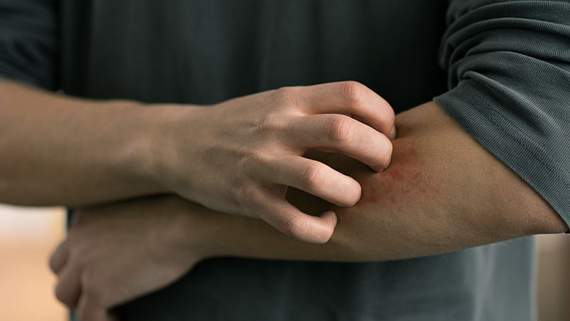 Anxiety Skin Rash: Effective Strategies and Tips - Senior Fitness